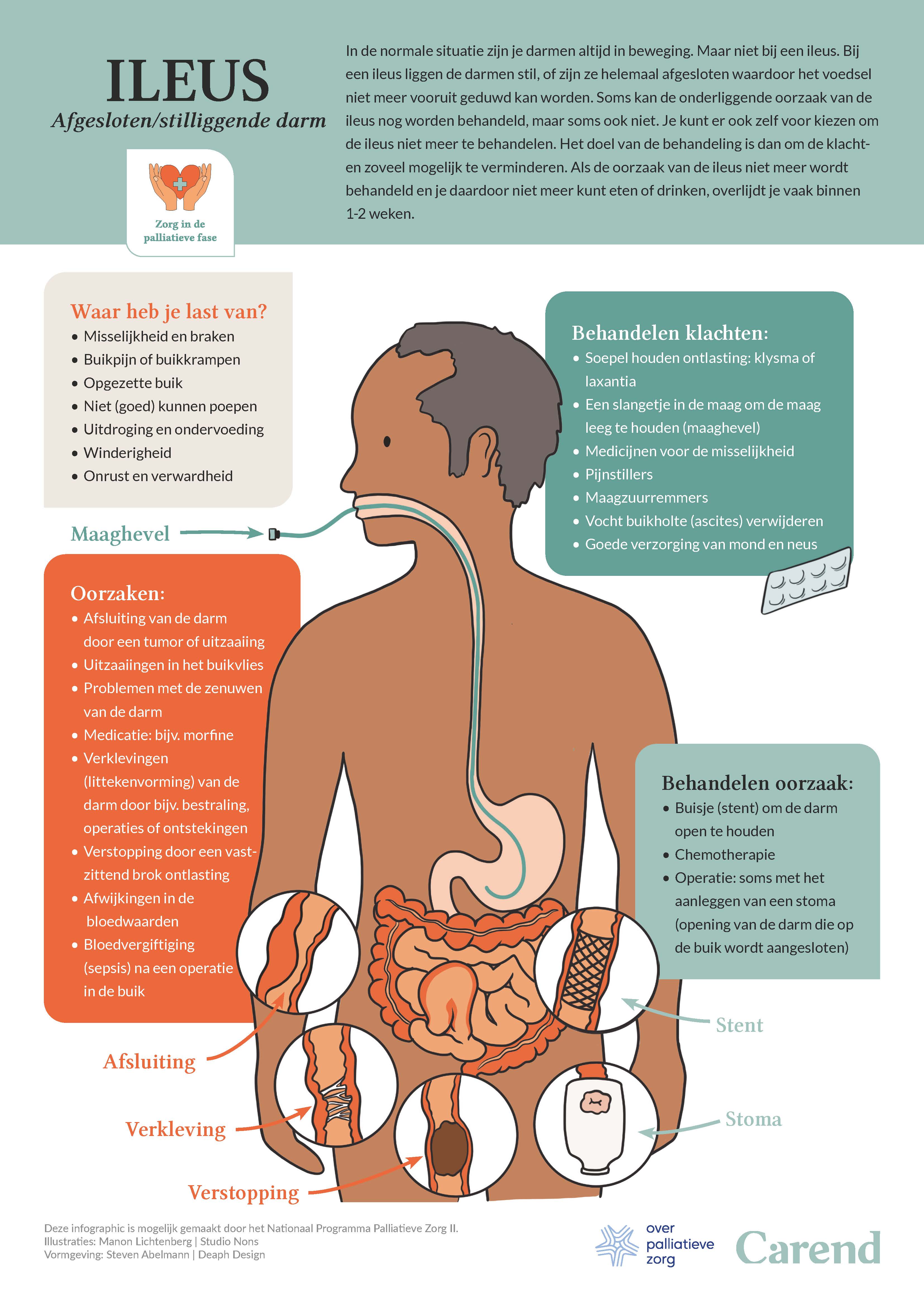 Je kunt de infographic Ileus hier als pdf-document en hier als jpg-figuur downloaden.